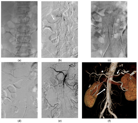 Microcatheter-Directed Thrombolysis Using Recombinant Tissue ...