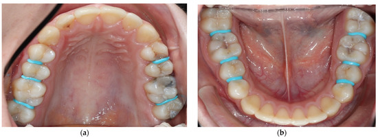 Introducing an Innovative Approach for Managing Proximal Non-Cavitated ...