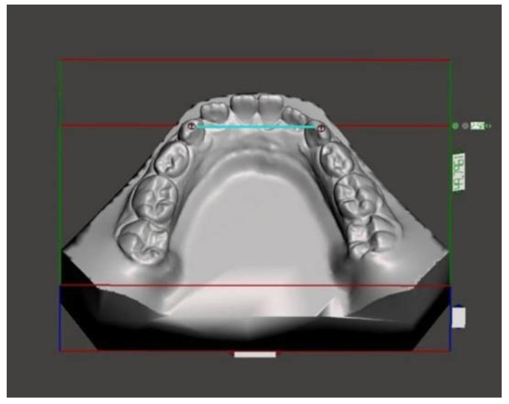 The Correlation between Mandibular Arch Shape and Vertical Skeletal Pattern