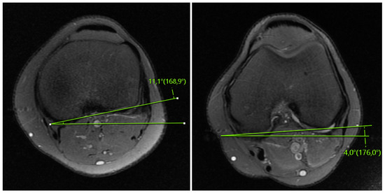 Does Rotation and Anterior Translation Persist as Residual Instability ...