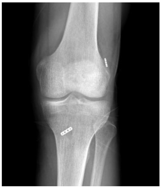 Does Rotation and Anterior Translation Persist as Residual Instability ...