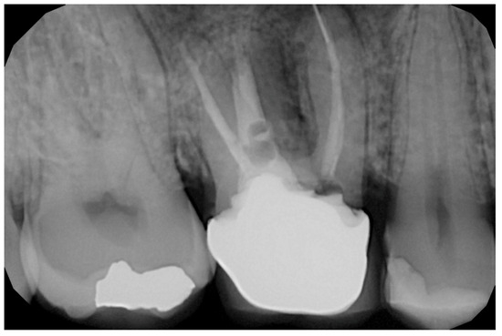The Use of Nano-Hydroxyapatite (NH) for Socket Preservation ...