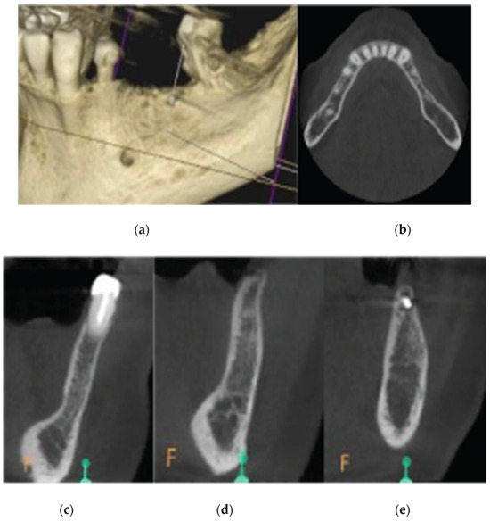 The Poncho Lamina Technique: A Protocol for Hard and Soft Tissue ...