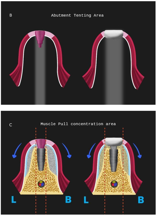 The Poncho Lamina Technique: A Protocol for Hard and Soft Tissue ...