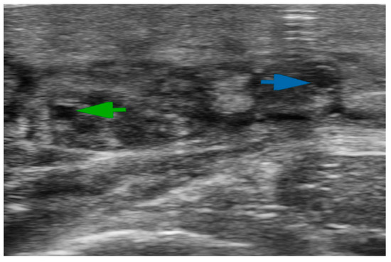 Imaging Modalities for Evaluating Lymphedema