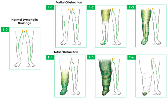 Imaging Modalities for Evaluating Lymphedema
