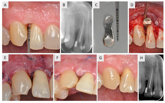 Regeneration of Intrabony Defects Using a Novel Magnesium Membrane