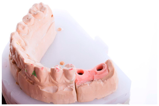 Three-Dimensional Scanning Accuracy of Intraoral Scanners for Dental ...