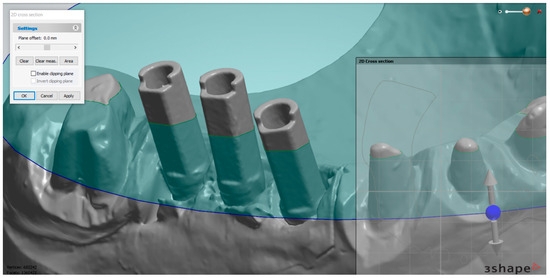 Medicina | Free Full-Text | Three-Dimensional Scanning Accuracy of Intraoral Scanners for Dental ...