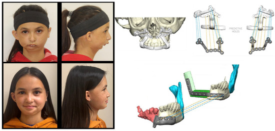 Current Trends in Orthognathic Surgery