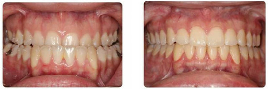 Current Trends in Orthognathic Surgery