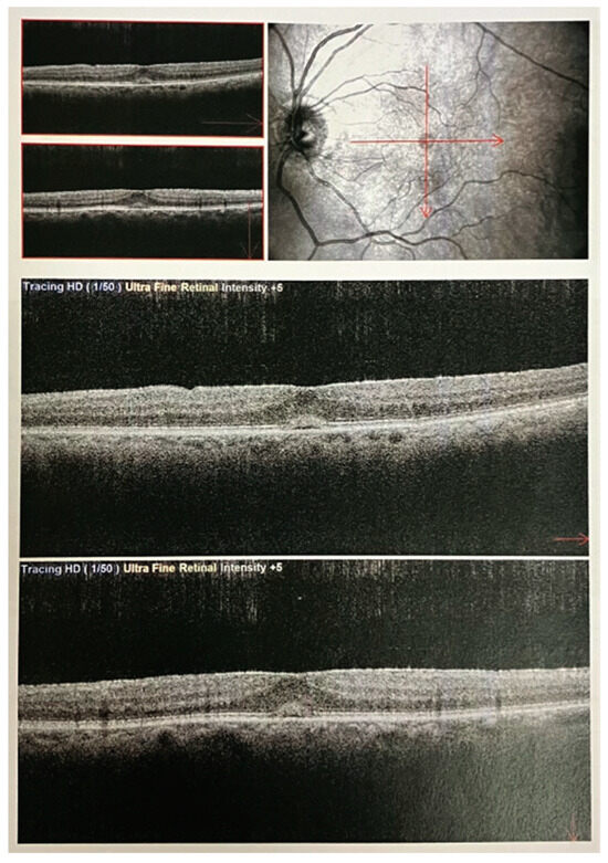 Medicina | Free Full-Text | Optical Coherence Tomography (OCT): A Brief ...