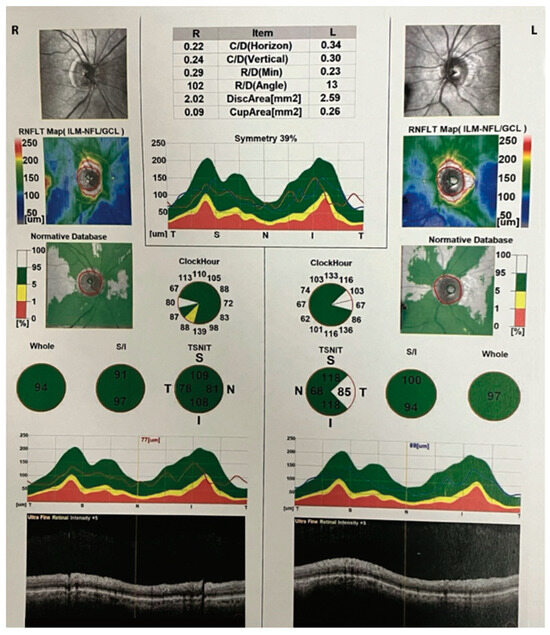 Medicina | Free Full-Text | Optical Coherence Tomography (OCT): A Brief ...