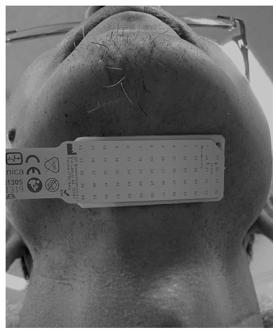 Swallowing Exercise Evaluated Using High-Density Surface ...