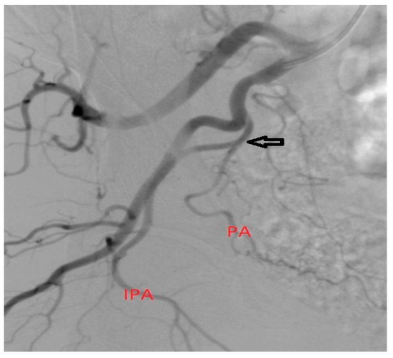 Prostatic Artery Origin Variability: Five Steps to Improve ...