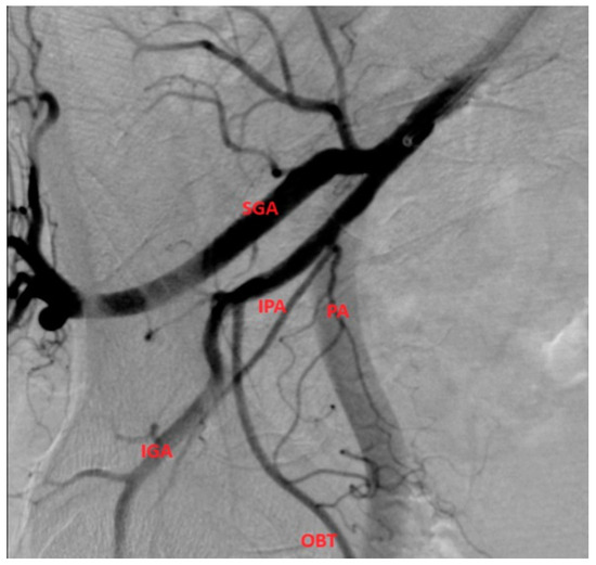Prostatic Artery Origin Variability: Five Steps to Improve ...