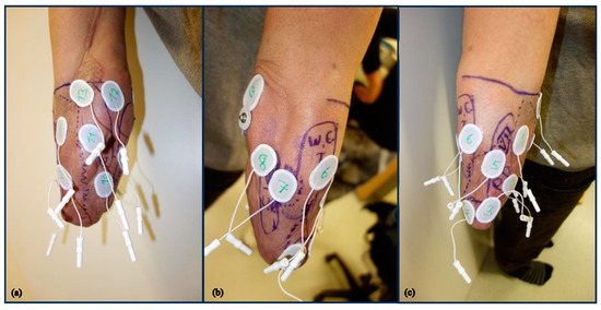 Combining Surgical Innovations in Amputation Surgery—Robotic Harvest of ...