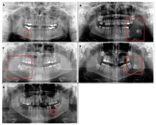 Detection and Segmentation of Radiolucent Lesions in the Lower Jaw on Panoramic Radiographs ...