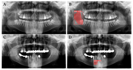 Detection and Segmentation of Radiolucent Lesions in the Lower Jaw on Panoramic Radiographs ...