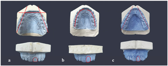 Correlation Theory of the Maxillary Central Incisor, Face and Dental ...