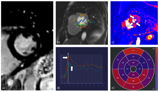 Coronary Microvascular Dysfunction and Hypertension: A Bond More ...