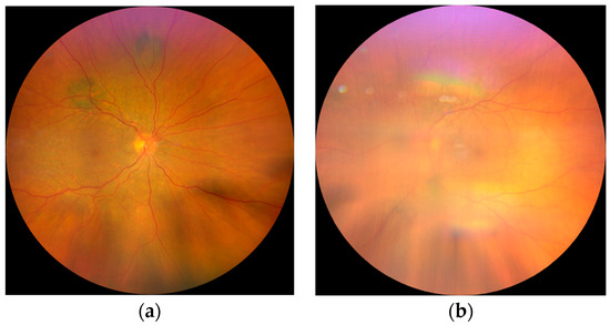 Management of Bilateral Diffuse Uveal Melanocytic Proliferation (BDUMP ...