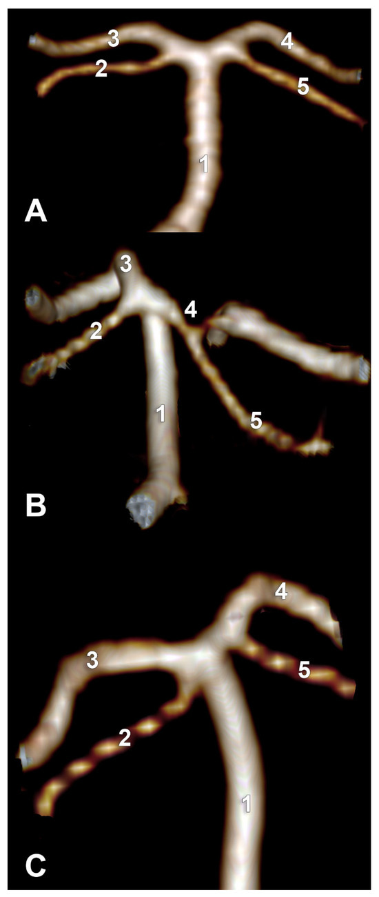 An Update on the Superior Cerebellar Artery Origin Type