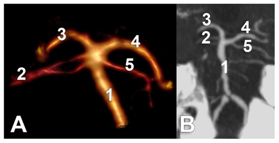 An Update on the Superior Cerebellar Artery Origin Type
