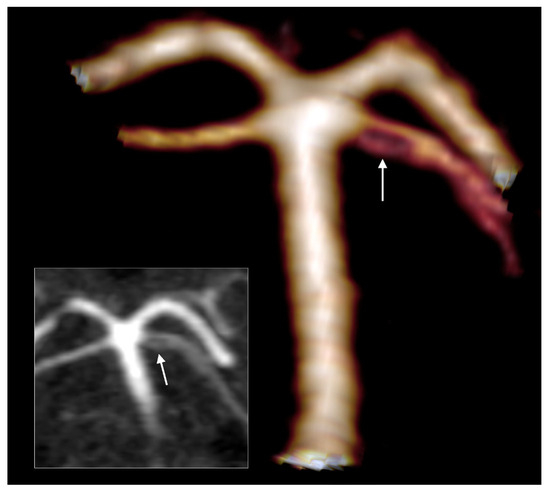 An Update on the Superior Cerebellar Artery Origin Type