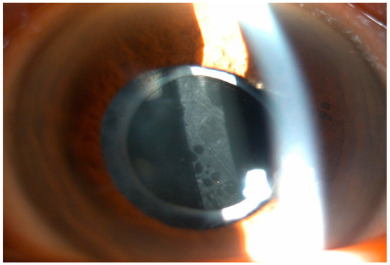 Comparison of the Incidence of Nd:YAG Laser Capsulotomy Based on the ...