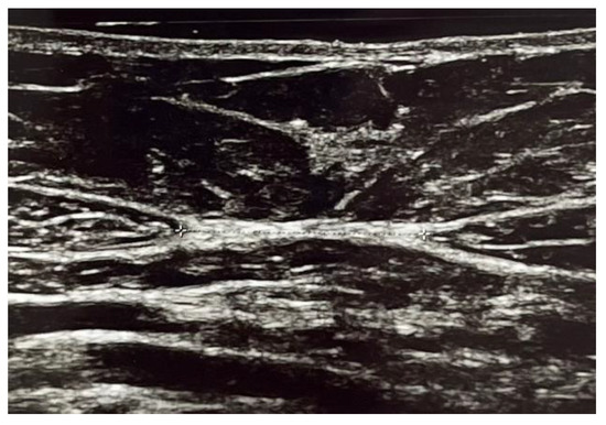 Is Diastasis Recti Abdominis Rehabilitation after Childbirth Able to ...