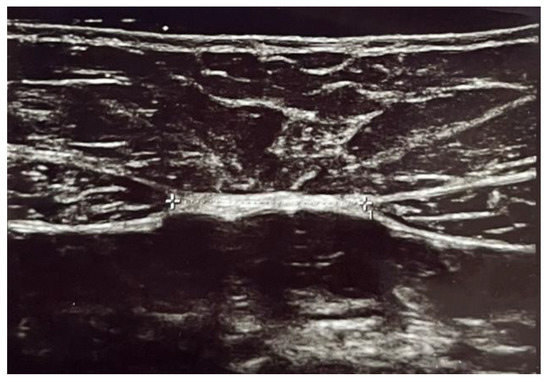 Is Diastasis Recti Abdominis Rehabilitation after Childbirth Able to ...