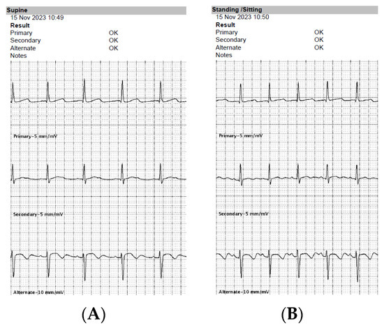 Comparison of Preoperative ECG Screening and Device-Based Vector ...