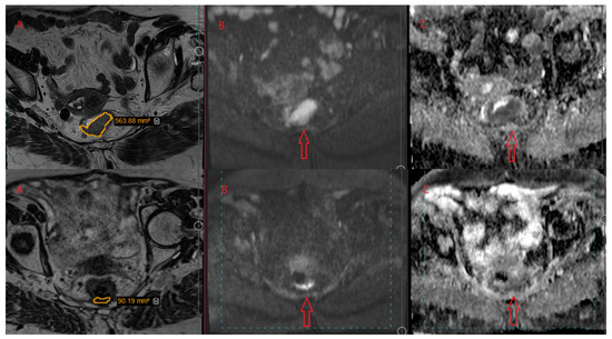 Prognostic Value of Tumor Volume, Tumor Volume Reduction Rate and ...