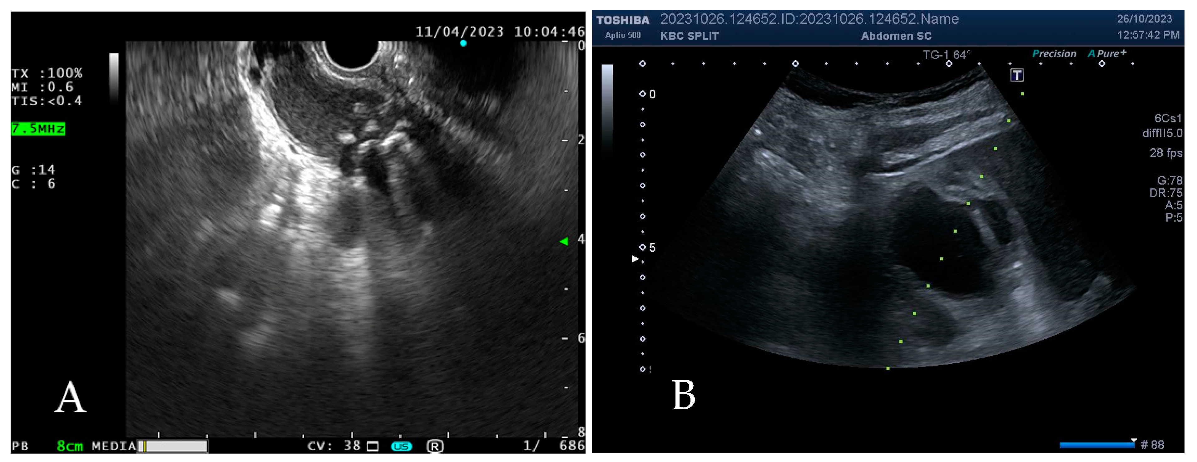 Assessment of Gallbladder Drainage Methods in the Treatment of Acute ...