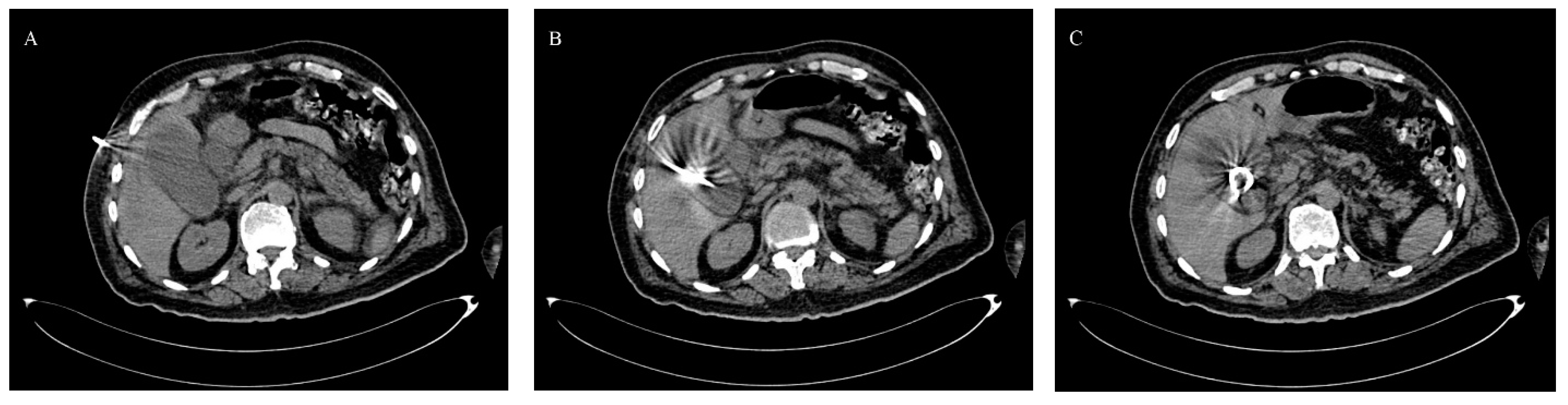 Assessment of Gallbladder Drainage Methods in the Treatment of Acute ...
