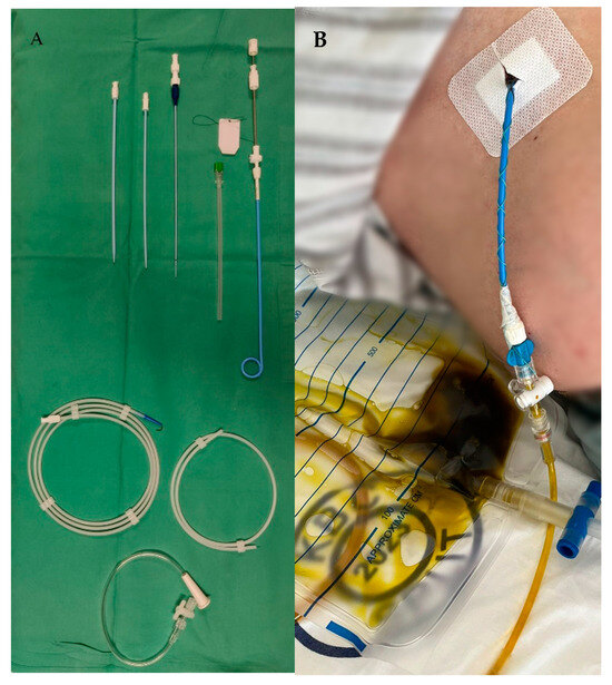 Assessment of Gallbladder Drainage Methods in the Treatment of Acute ...