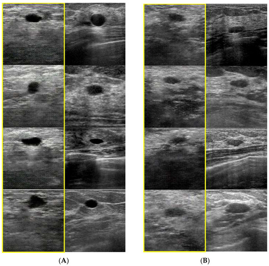Clinical Utility of Breast Ultrasound Images Synthesized by a ...
