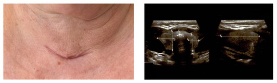 Pitfalls of DualTracer 99m-Technetium (Tc) Pertechnetate and Sestamibi ...