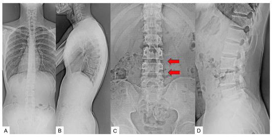 New Spinal Shortening Technique for Tethered Cord Syndrome: A Technical ...