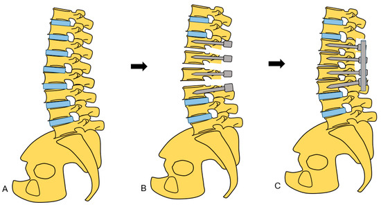 New Spinal Shortening Technique for Tethered Cord Syndrome: A Technical ...