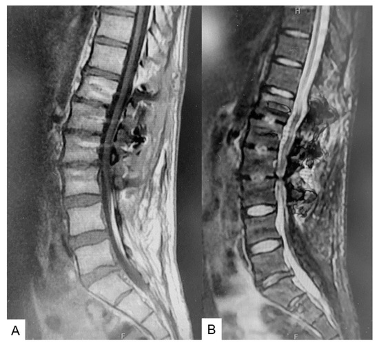 New Spinal Shortening Technique for Tethered Cord Syndrome: A Technical ...