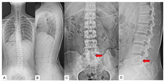 New Spinal Shortening Technique for Tethered Cord Syndrome: A Technical ...