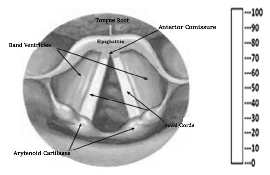 Comparison of the Effectiveness of the Miller Laryngoscope and the ...