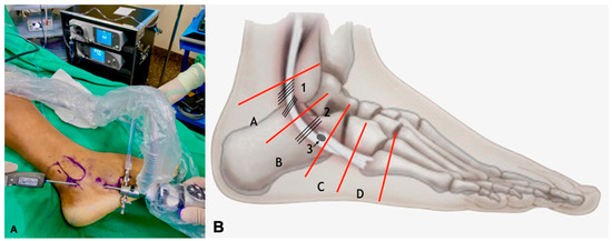 Medicina | Free Full-Text | Minimally Invasive Peroneal Tenodesis ...