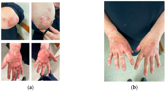 Paradoxical Psoriasis Induced by Ustekinumab: A Comprehensive Review ...