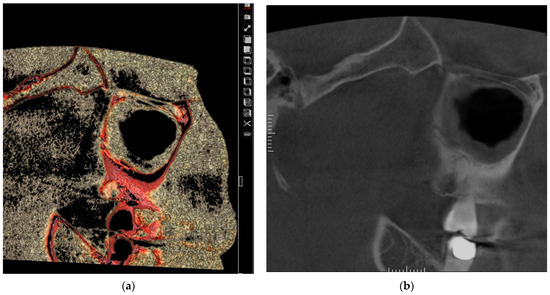 Utilizing a Novel AI Tool to Detect the Posterior Superior Alveolar ...