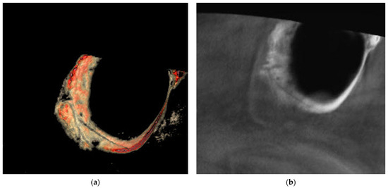 Utilizing a Novel AI Tool to Detect the Posterior Superior Alveolar ...