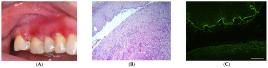 Gingival Manifestations in Oral Chronic Autoimmune Bullous Diseases: A ...