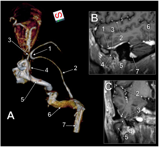 The Basal or Sphenopetrosal Superficial Middle Cerebral Vein Type